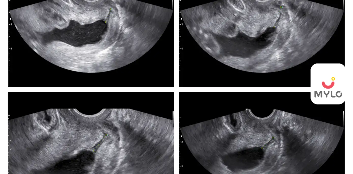 Everything You Need To Know About Anomaly Scan During Pregnancy Everything You Need To Know About Anomaly Scan During Pregnancy